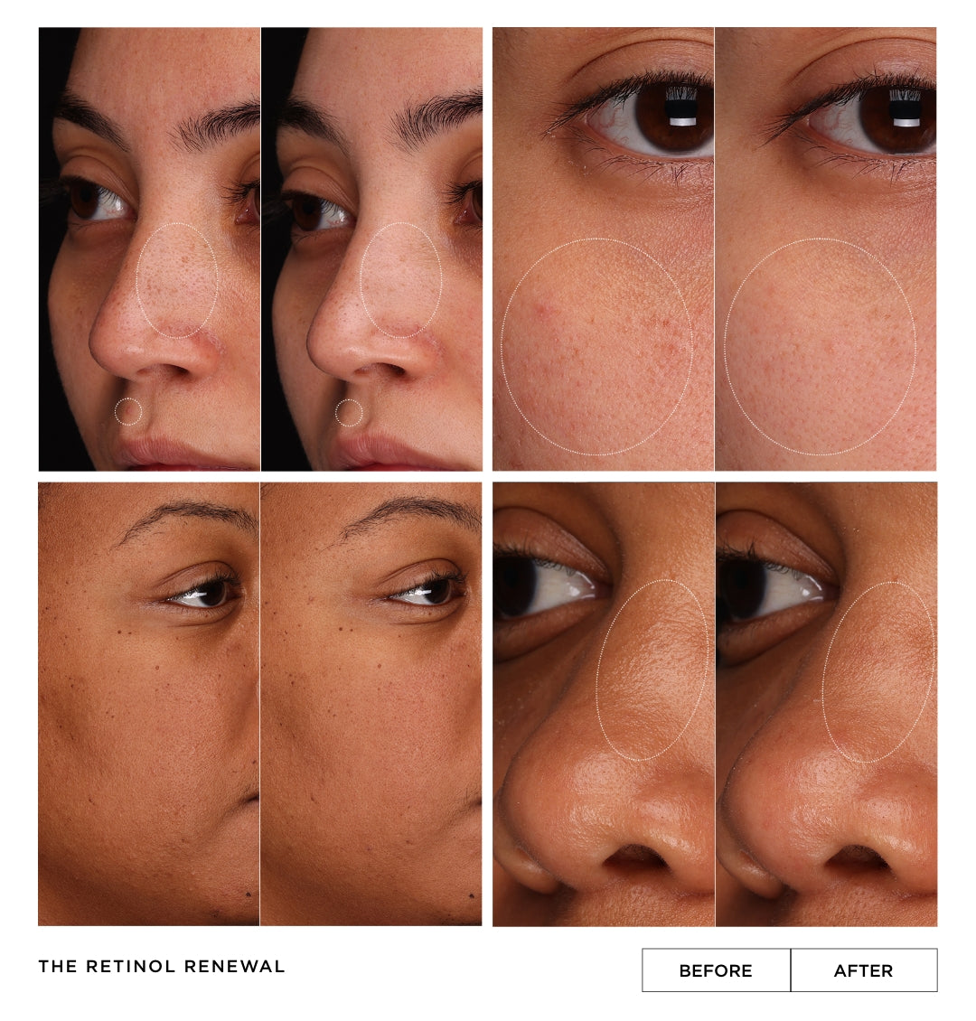 Revolutionary Retinol Renewal Treatment | Blemish-Free, Youthful Complexion – LALAIS